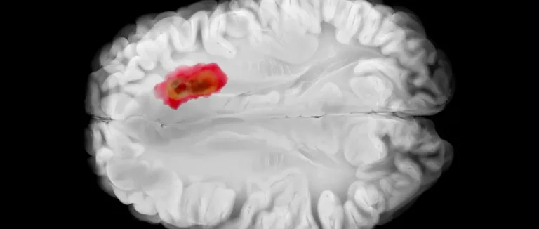 7 Key Findings on Brain Neoplasm MRI: Essential Guide