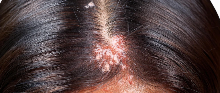Seboreik Dermatit Nedir Belirtileri Ve Tedavisi Liv Hospital
